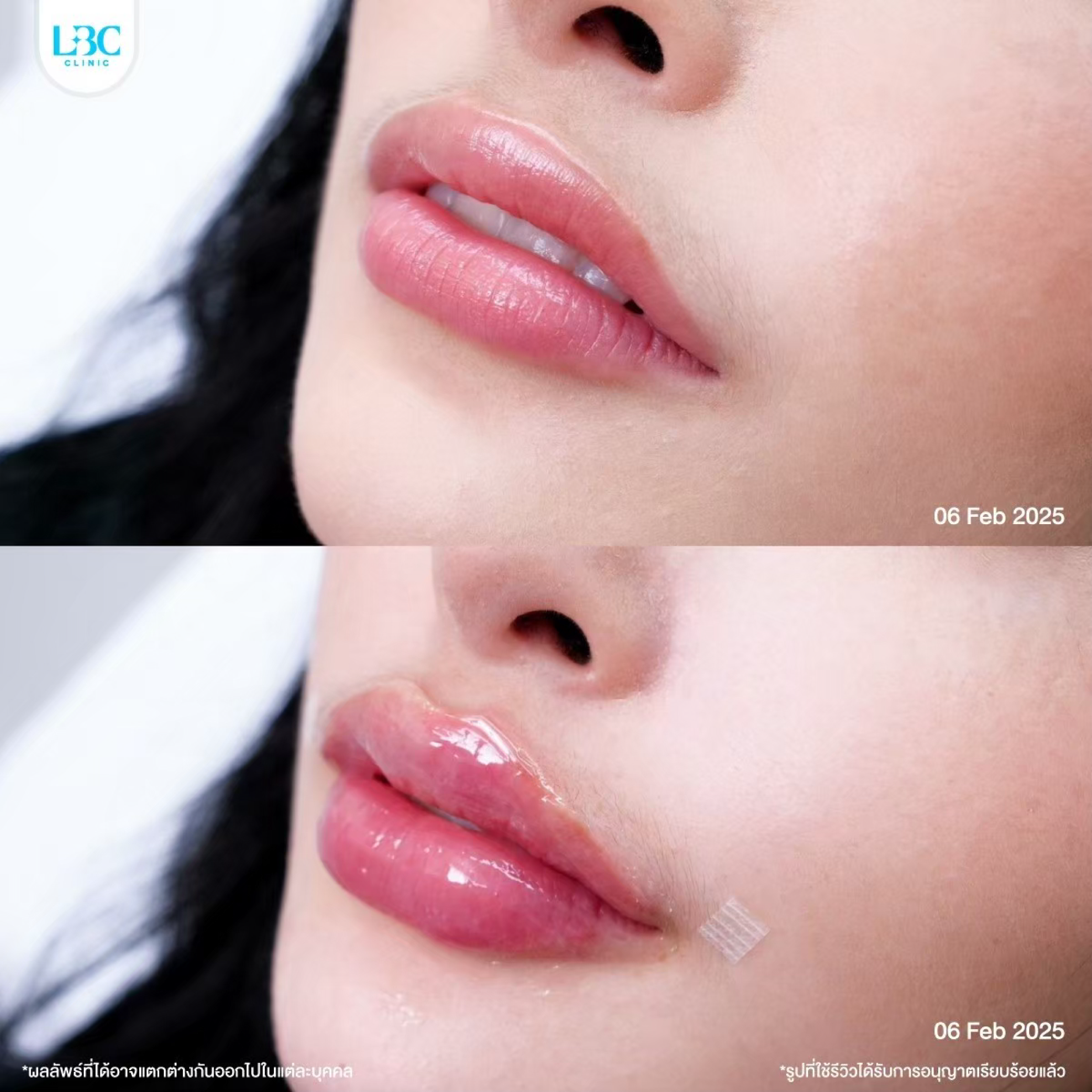 Barbie Lips ที่ LBC Clinic - LBC Clinic